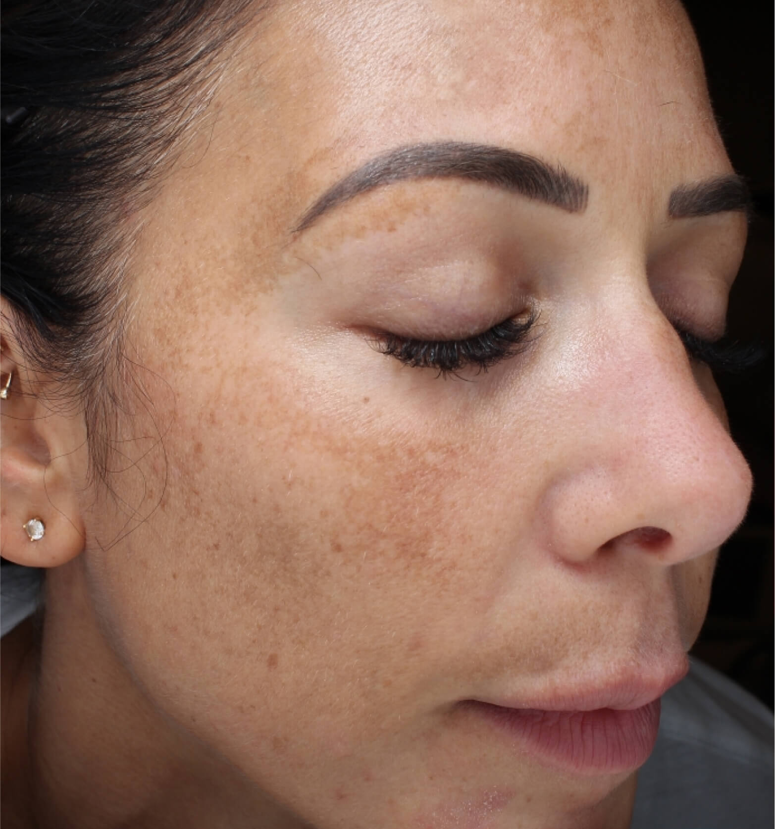 The Hyperpigmentation Solution